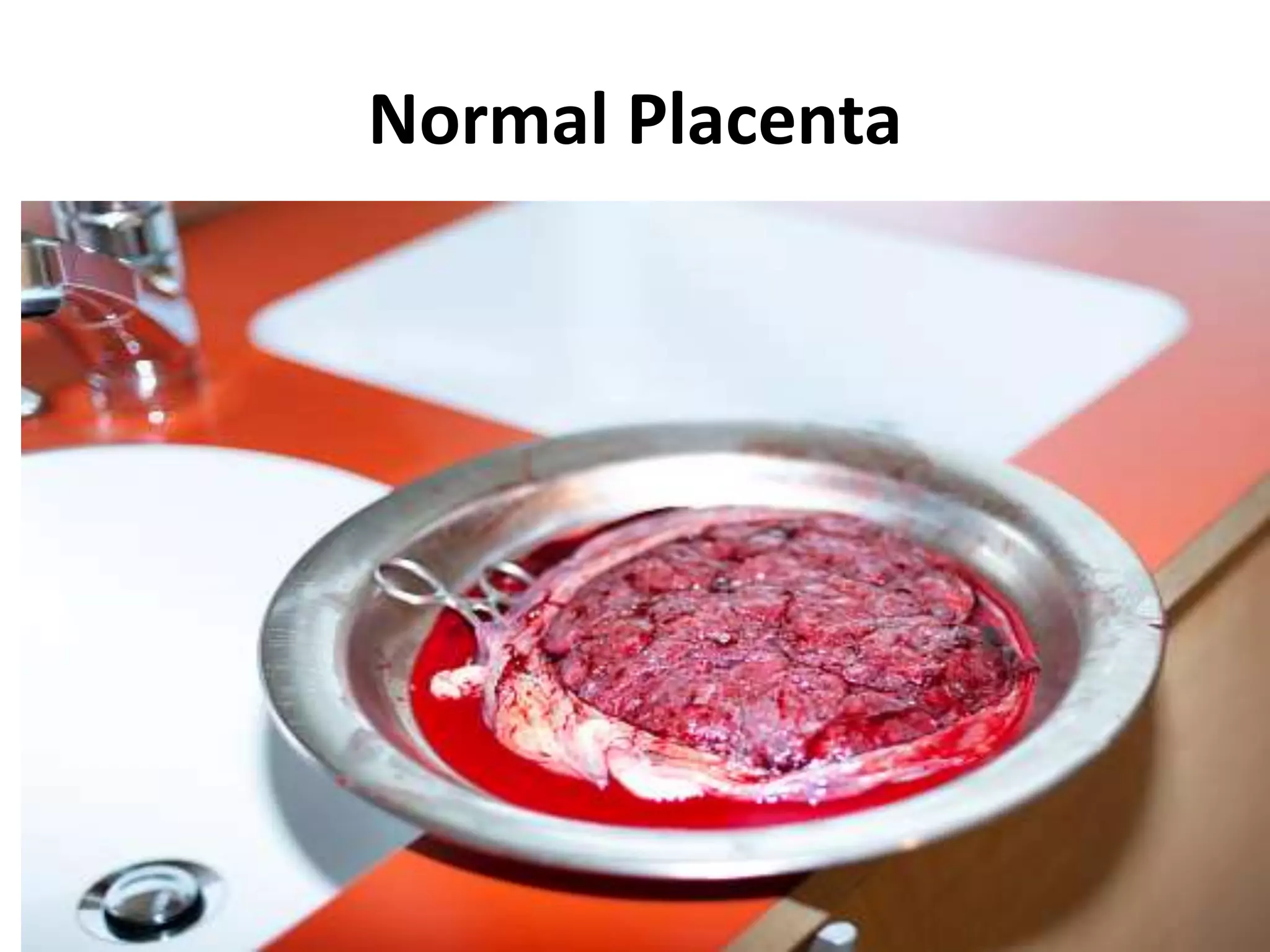 abnormalities of Placenta.pptx