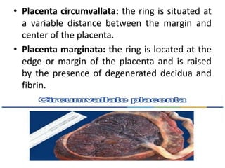abnormalities of Placenta.pptx