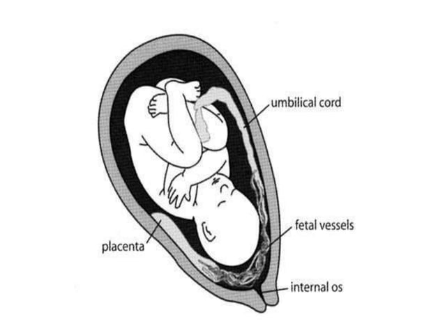 abnormalities of Placenta.pptx | Pregnancy | Reproductive Health