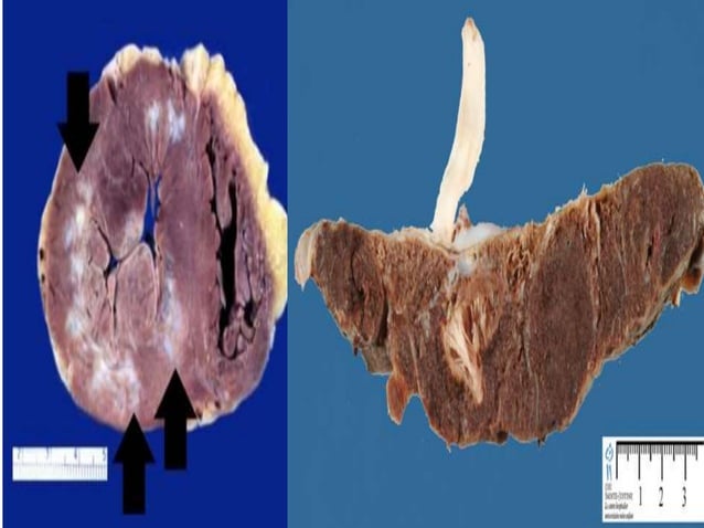 abnormalities of Placenta.pptx | Pregnancy | Reproductive Health