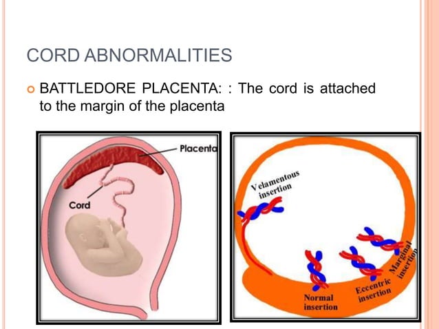 ABNORMALITIES OF PLACENTA AND CORD.pptx | Pregnancy | Reproductive Health