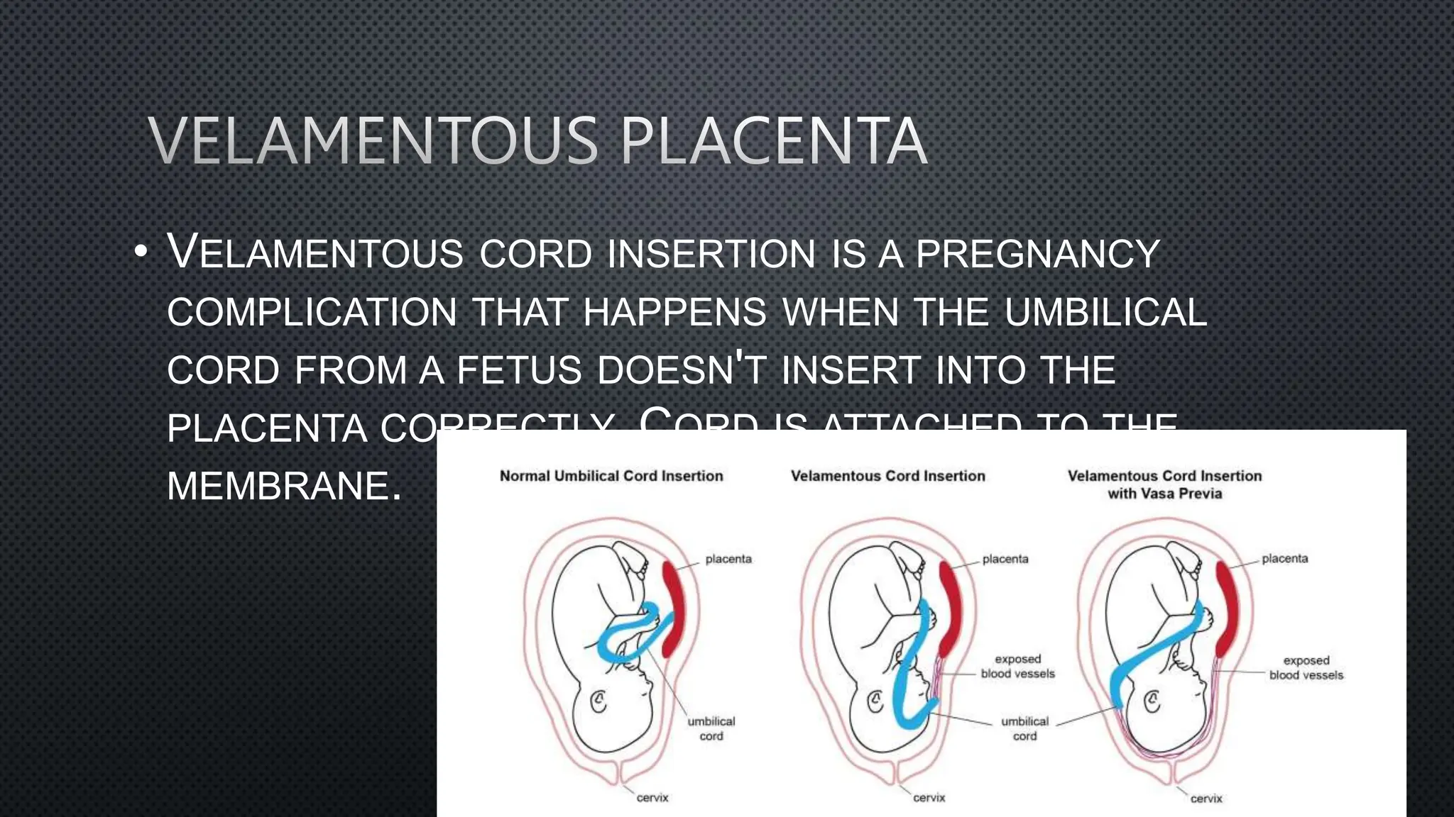 Abnormalities of placenta and cord (1).pptx | Pregnancy | Reproductive Health