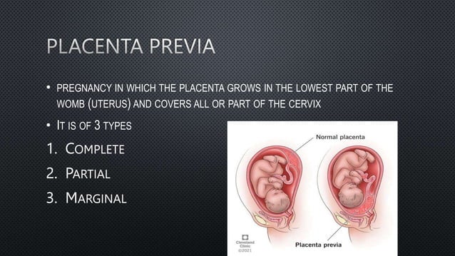 Abnormalities of placenta and cord (1).pptx
