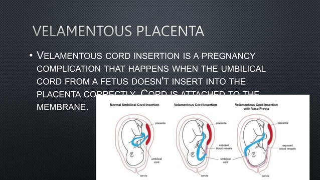 Abnormalities of placenta and cord (1).pptx