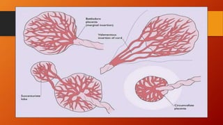 Placenta Extrachorialis