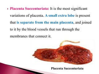 Placenta Succenturiata
