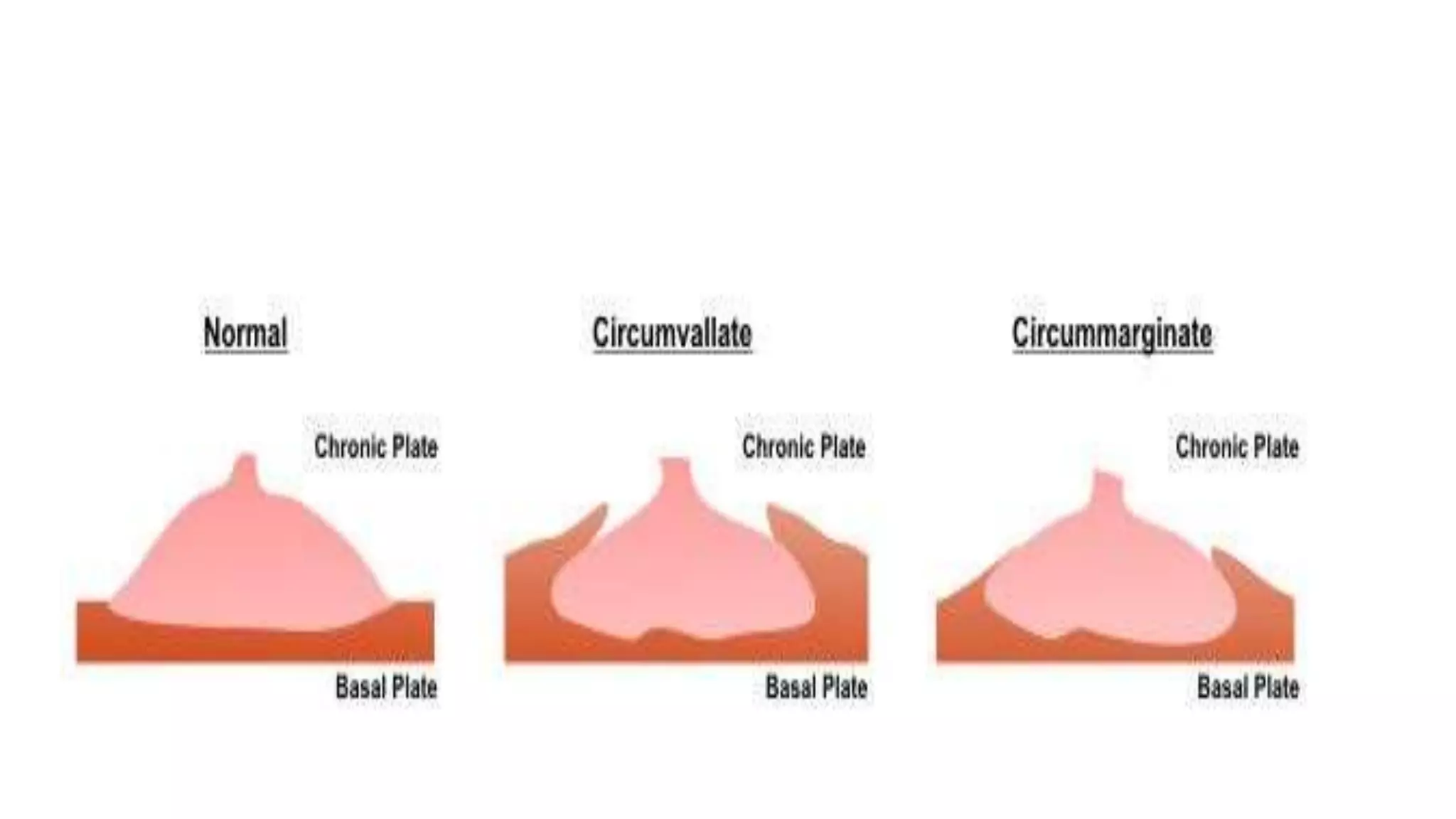 Abnormalities of placenta_cord_and_membrane | PPTX
