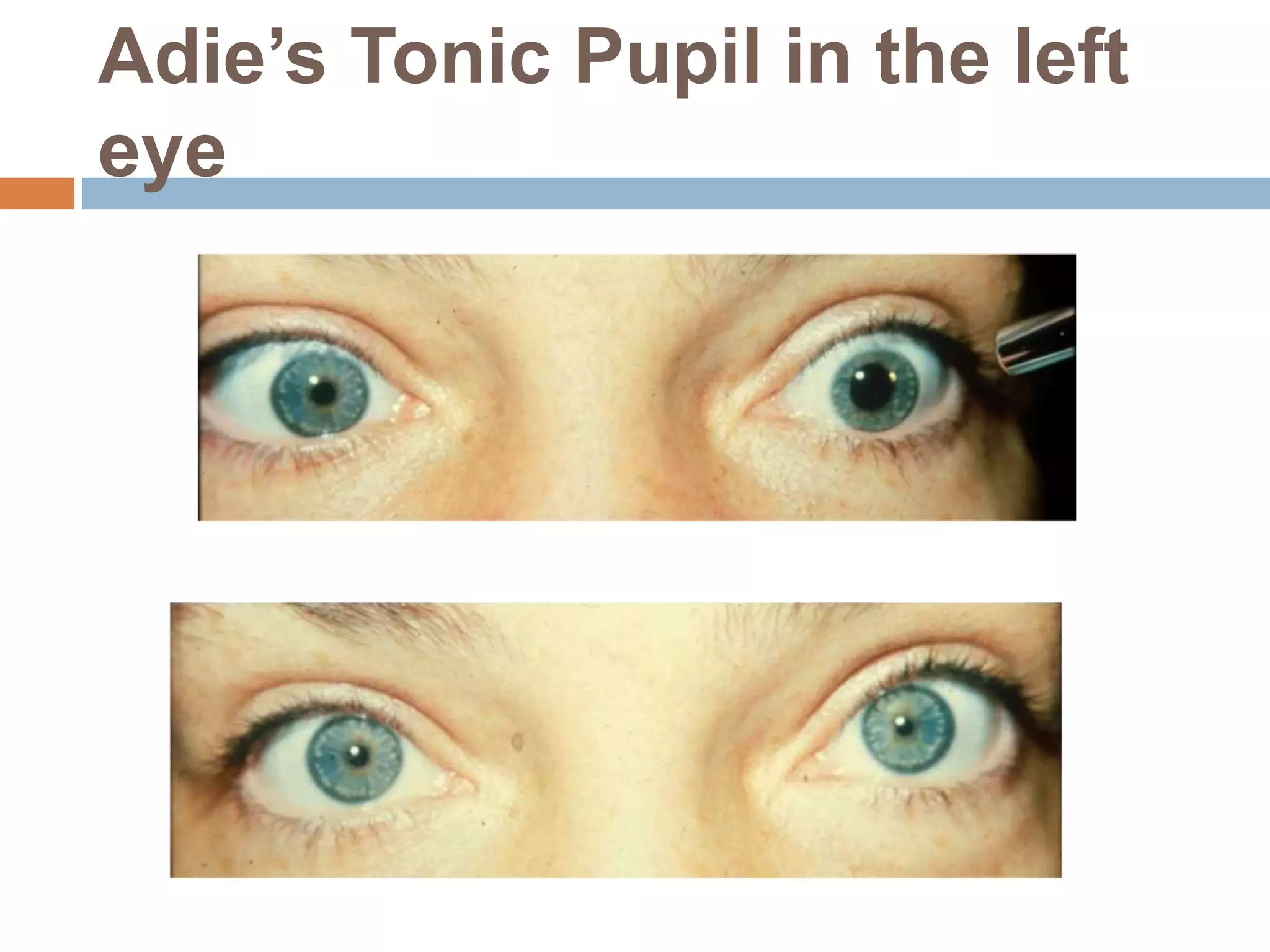 Abnormalities of pupil | PPTX