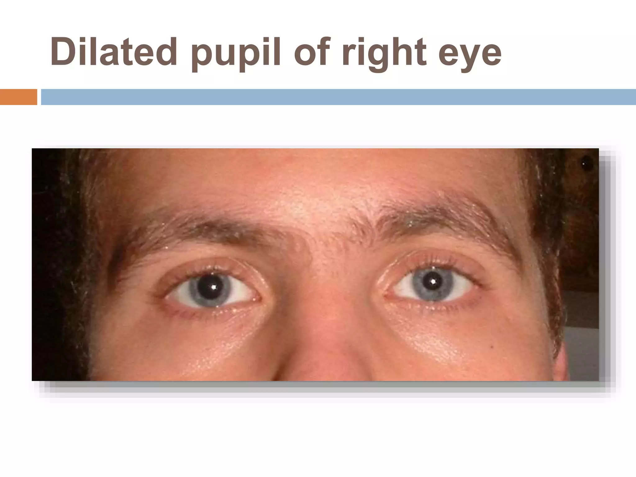 Abnormalities of pupil | PPTX