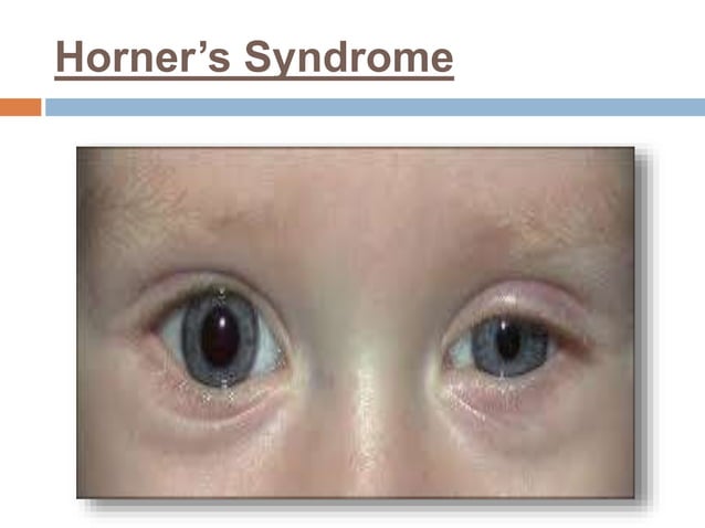 Abnormalities of pupil