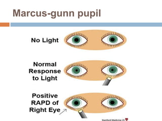 Abnormalities of pupil | PPT