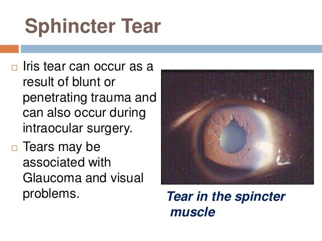 Abnormalities of pupil