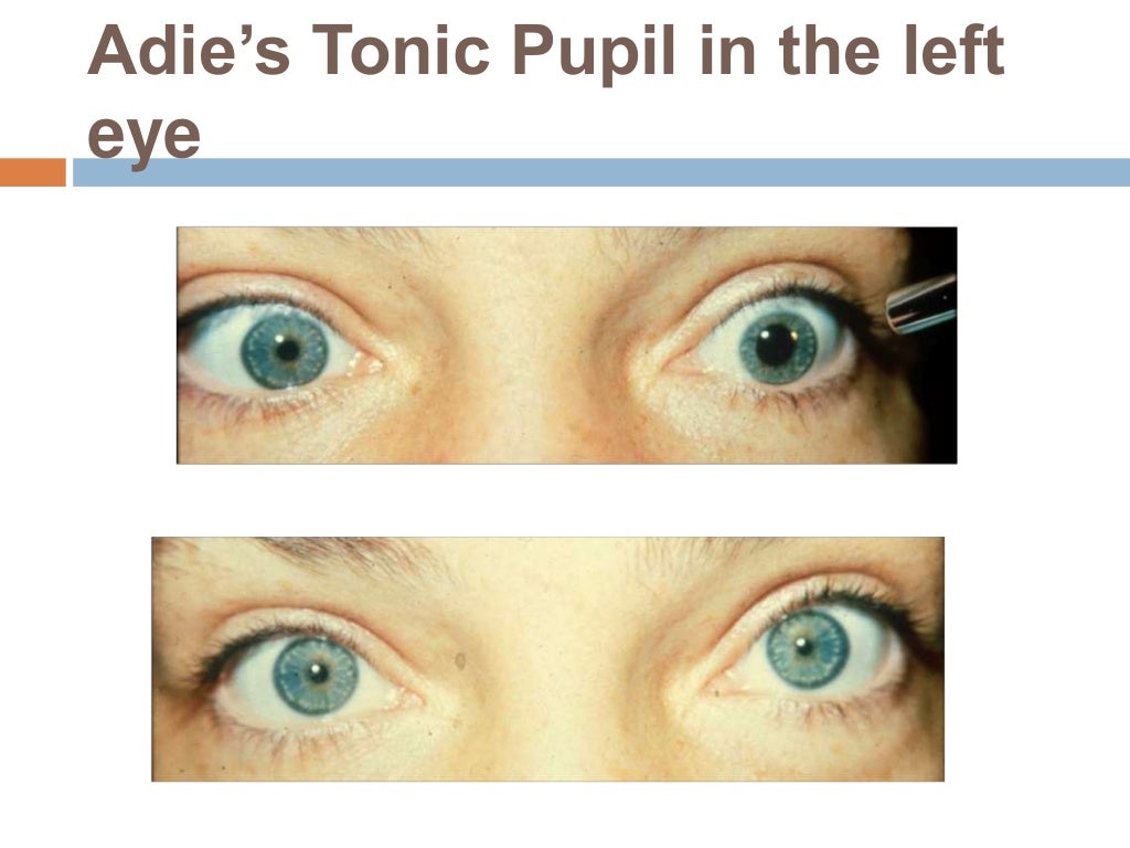 Abnormalities of pupil