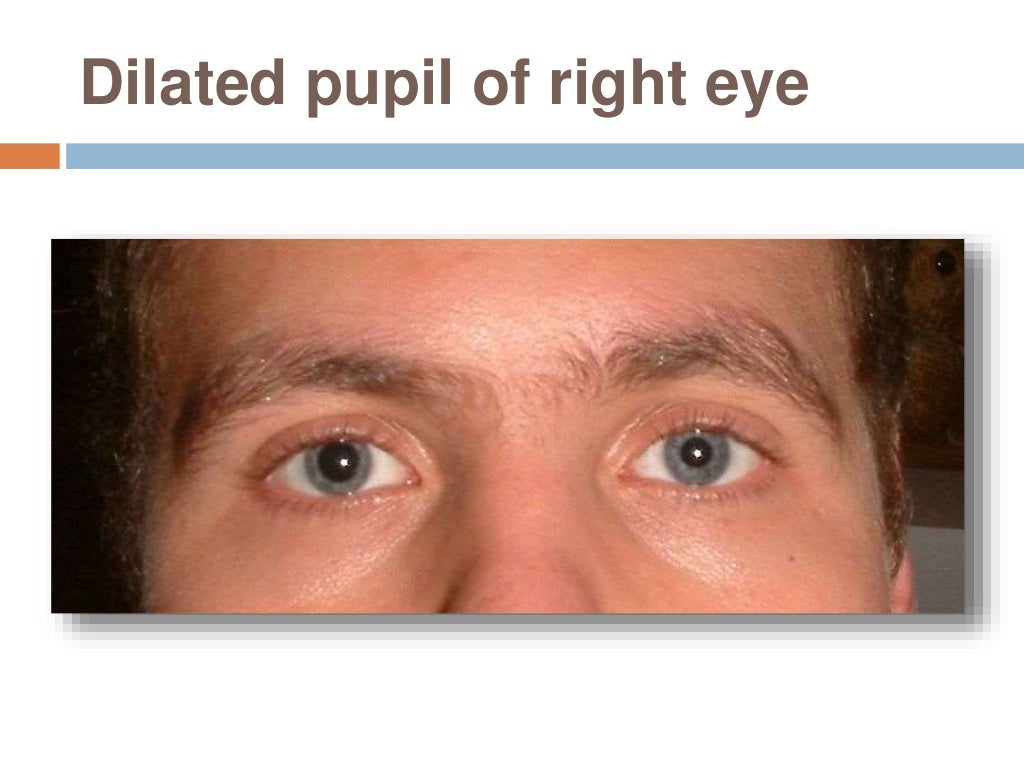 Abnormalities of pupil