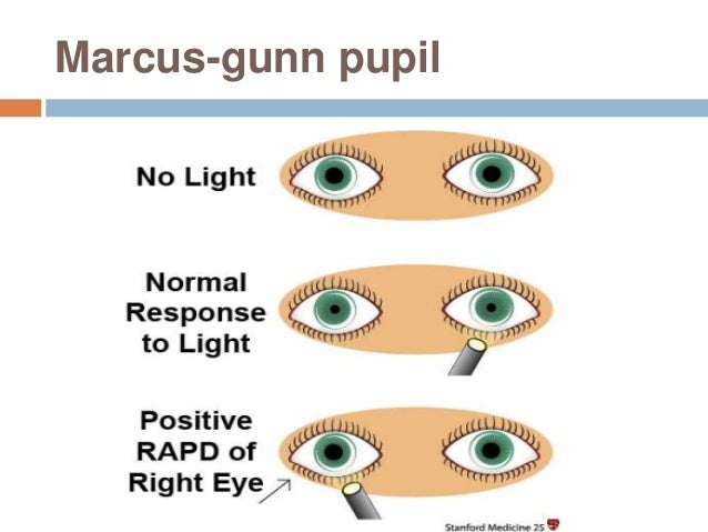 Afferent Pupillary Defect