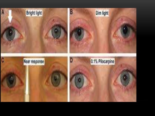 Abnormalities of pupillary reaction | PPTX