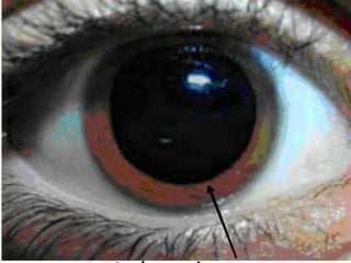 Abnormalities of pupillary reaction.pptx