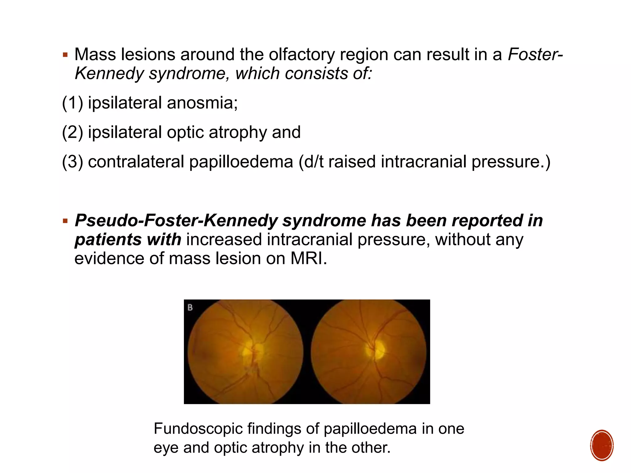 Abnormalities of smell(dr ravindra daggupati) | PPTX