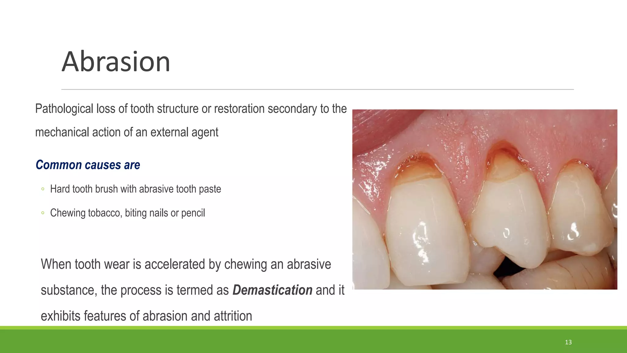 Abnormalities of teeth | PPTX