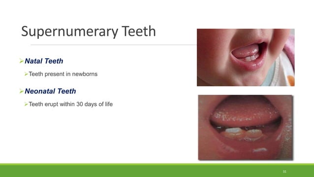 Abnormalities of teeth | PPTX