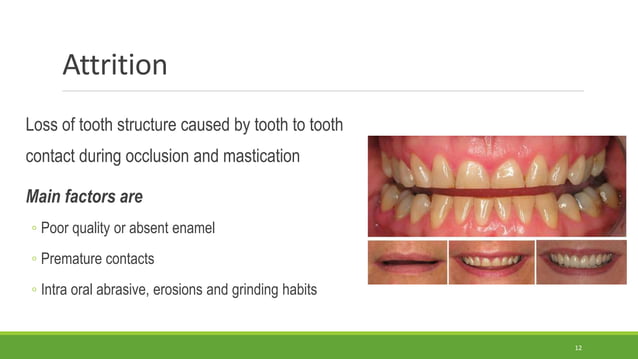 Abnormalities of teeth