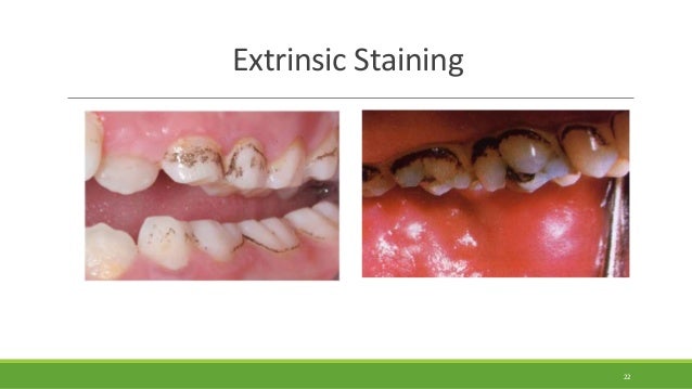 Abnormalities of teeth