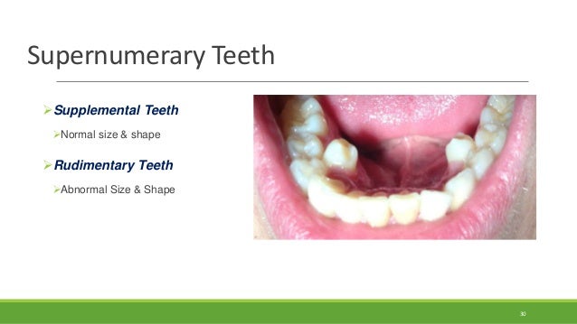 Abnormalities of teeth