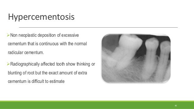Abnormalities of teeth