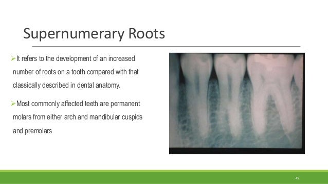 Abnormalities of teeth