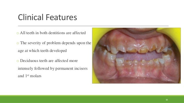 Abnormalities of teeth