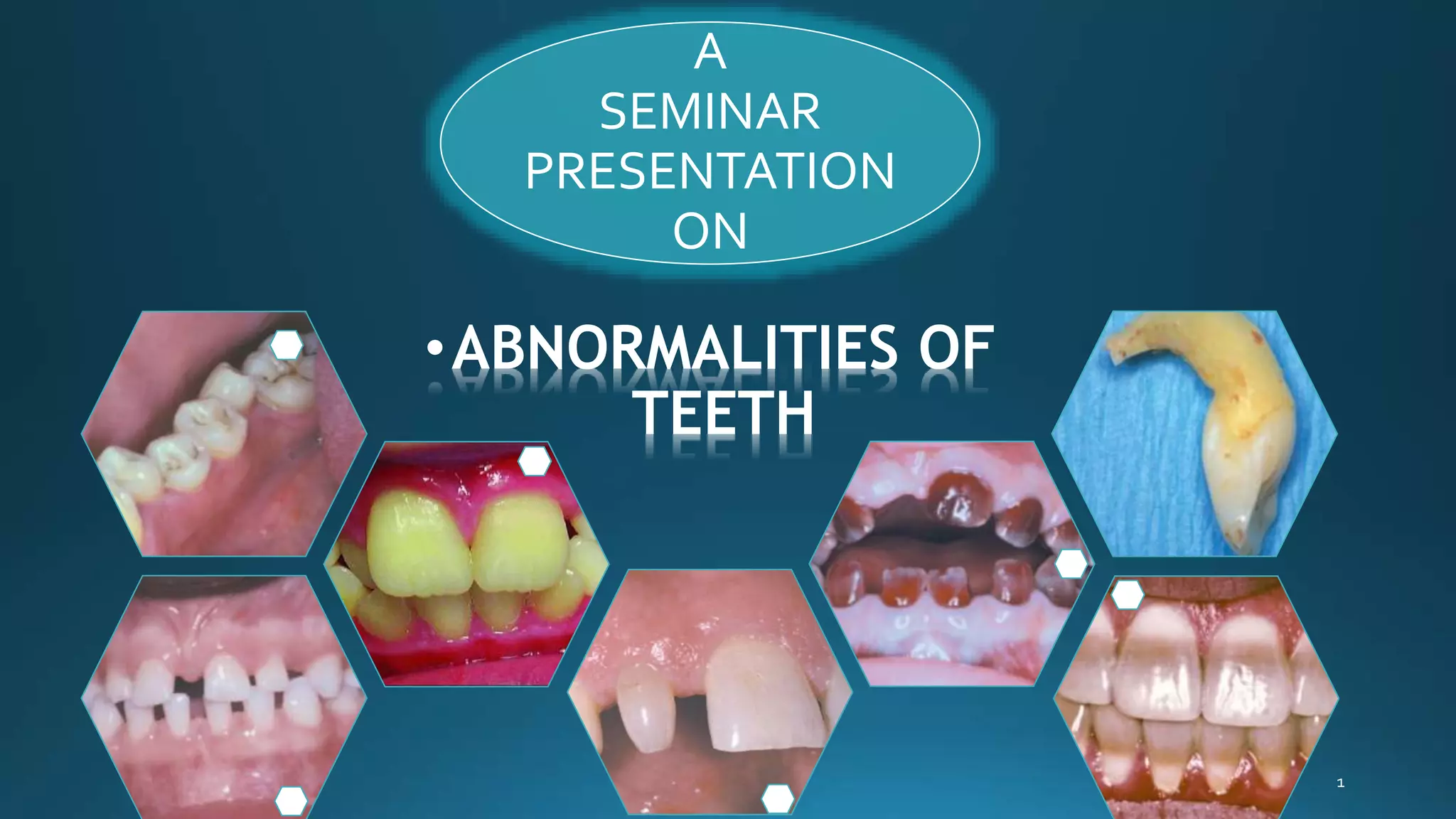 Abnormalities of teeth | PPTX