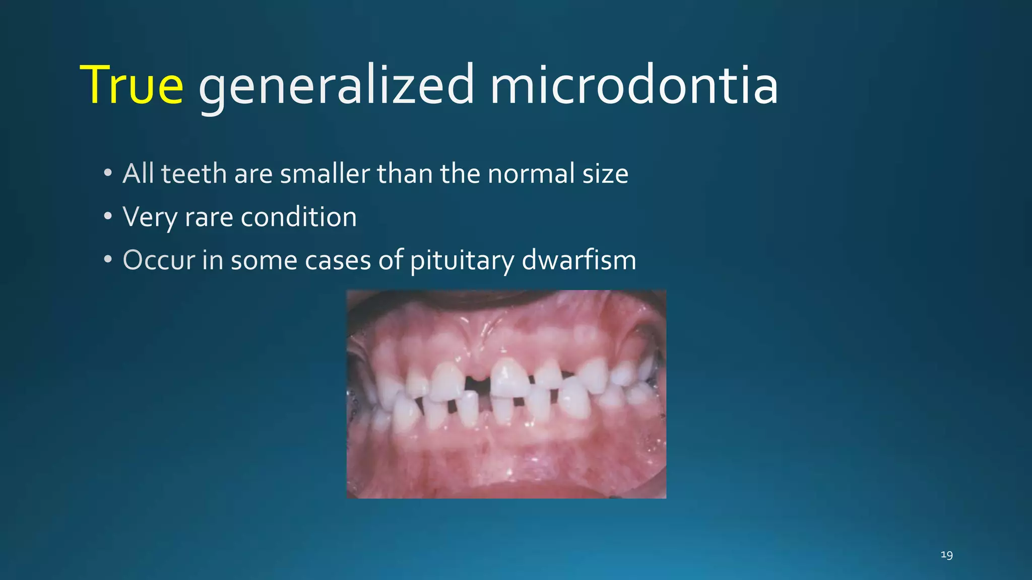 Abnormalities of teeth | PPTX