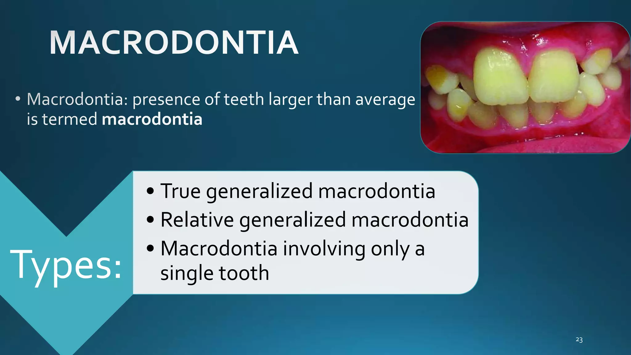 Abnormalities of teeth | PPTX