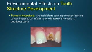 Abnormalities of teeth | PPTX
