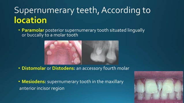 Abnormalities of teeth | PPTX | Dental Health | Diseases and Conditions
