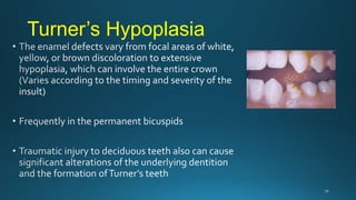 Turners Hypoplasia
