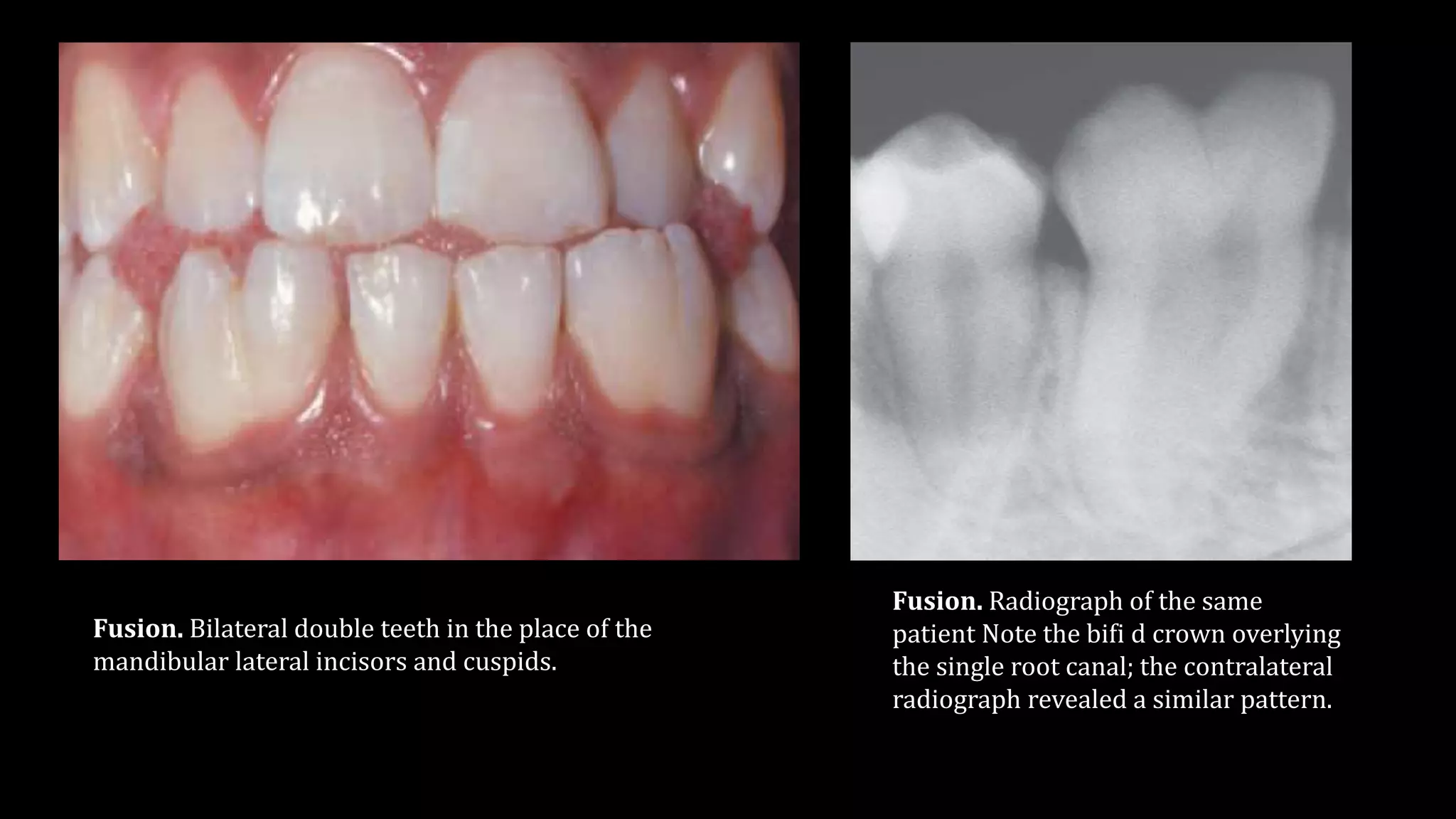 Abnormalities of teeth | PPTX | Dental Health | Diseases and Conditions