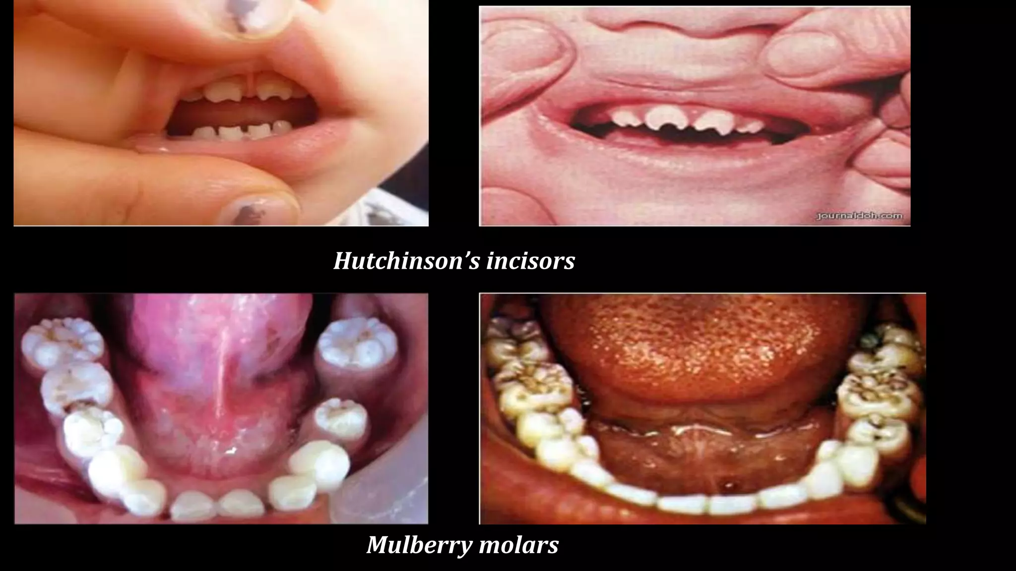 Abnormalities of teeth | PPTX