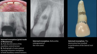 Abnormalities of teeth | PPTX