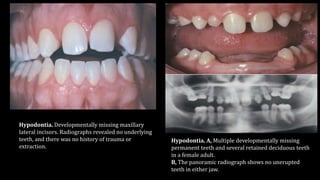 Abnormalities of teeth | PPTX