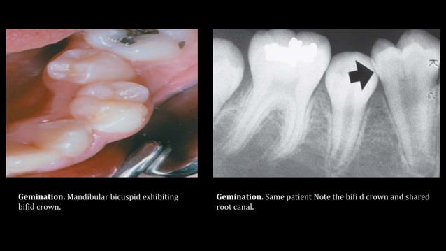Abnormalities of teeth | PPTX | Dental Health | Diseases and Conditions