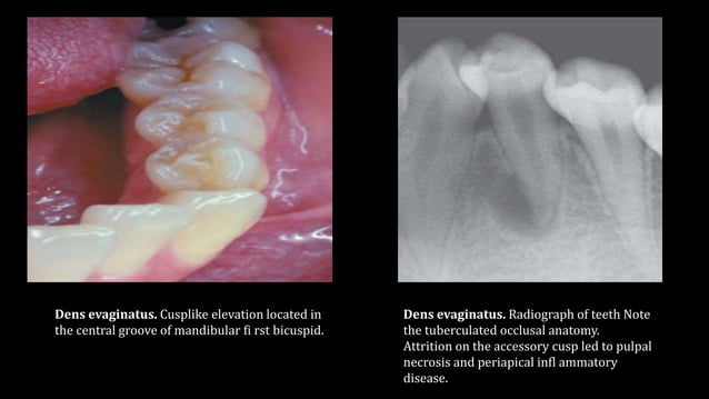 Abnormalities of teeth | PPTX | Dental Health | Diseases and Conditions
