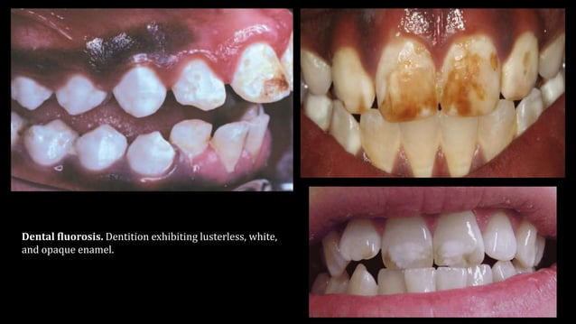 Abnormalities of teeth | PPTX | Dental Health | Diseases and Conditions