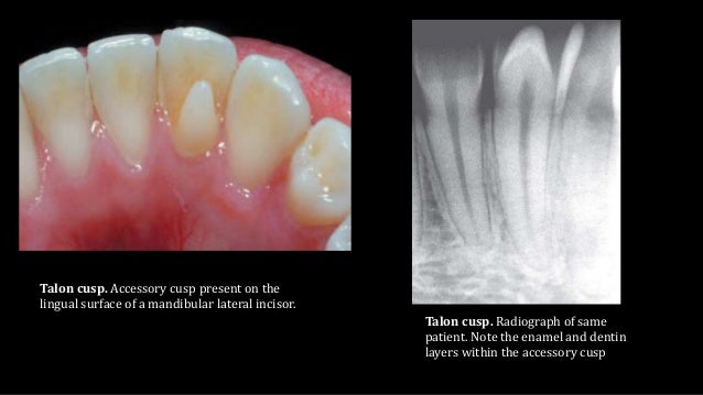 Abnormalities of teeth