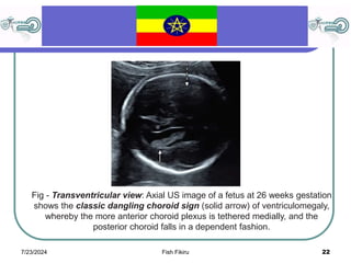 Abnormalities of the Fetal Central Nervous System Prenatal US Diagnosis ...
