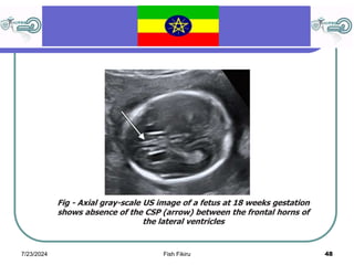 Abnormalities of the Fetal Central Nervous System Prenatal US Diagnosis ...
