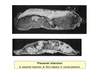 Abnormalities of the Placenta, Umbilical Cord and Membranes | PPT