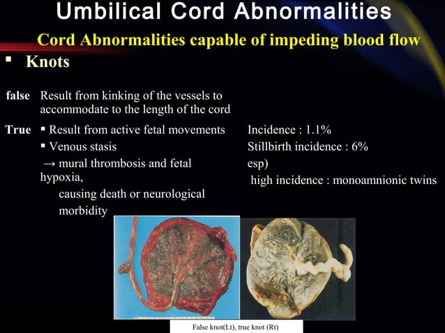 Abnormalities of the Placenta, Umbilical Cord and Membranes