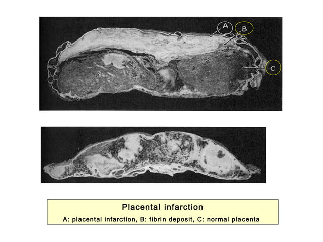 abnormalitiesoftheplacentaumbilicalcordandmembranes-140804071716 ...