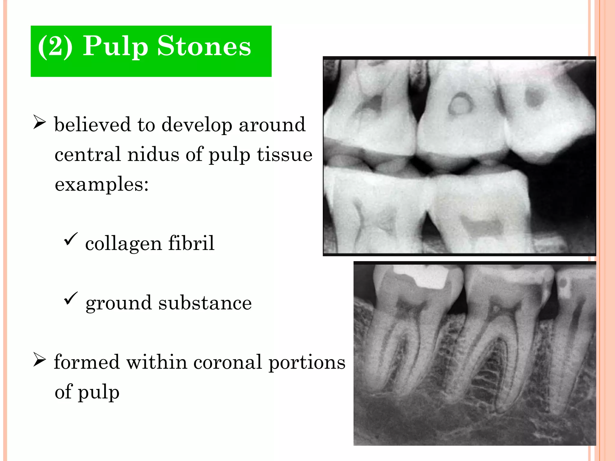 Abnormalities of the pulp | PPT